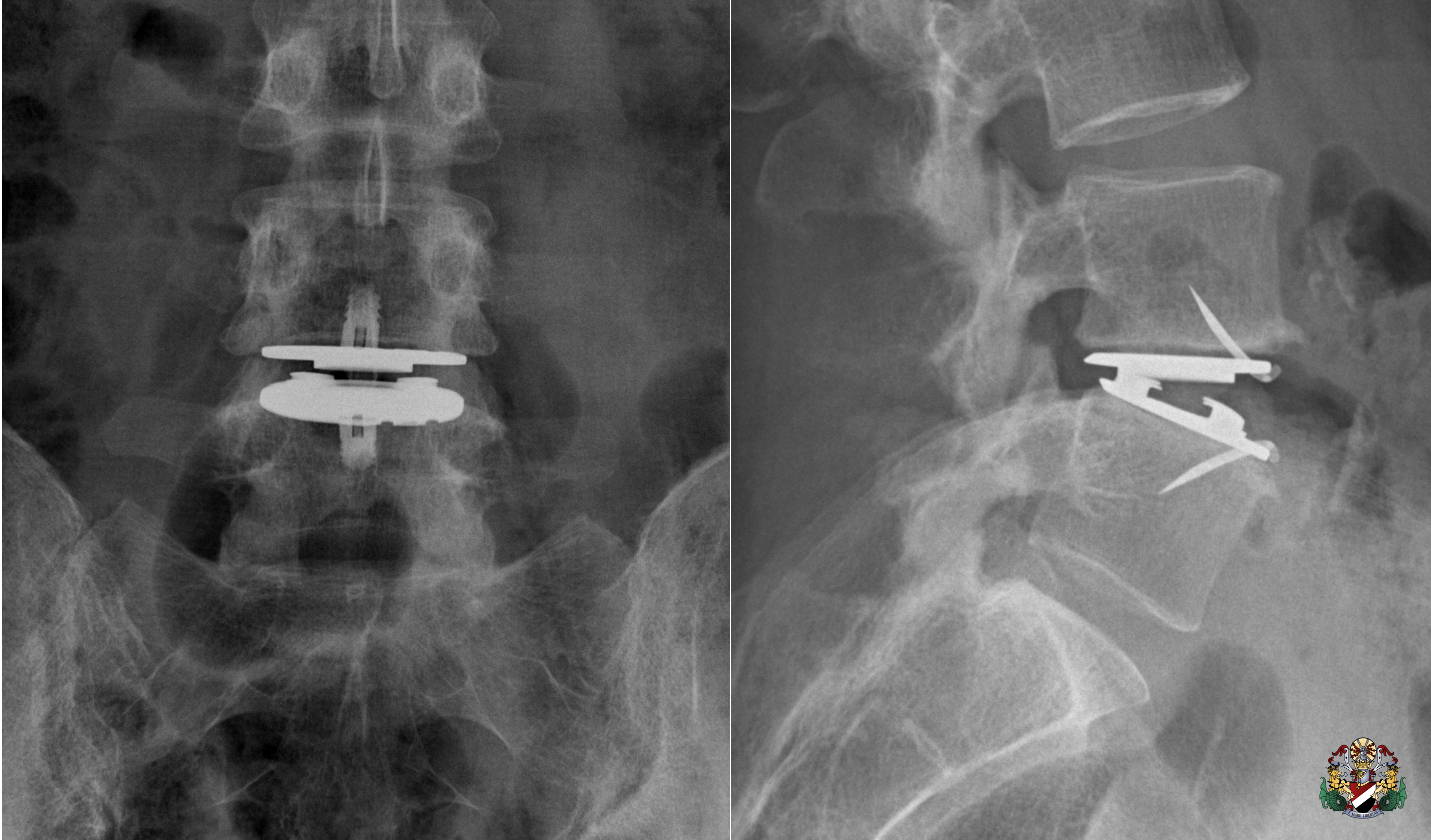 Lumbar Disc Arthroplasty – Sealand Spine Community